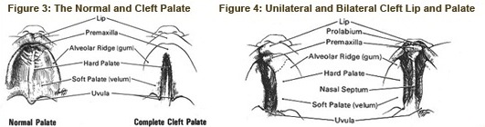 What is a cleft? - FACES Foundation