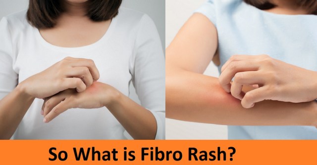 How to Deal With Fibromyalgia Rash and Skin Problems – Women With ...