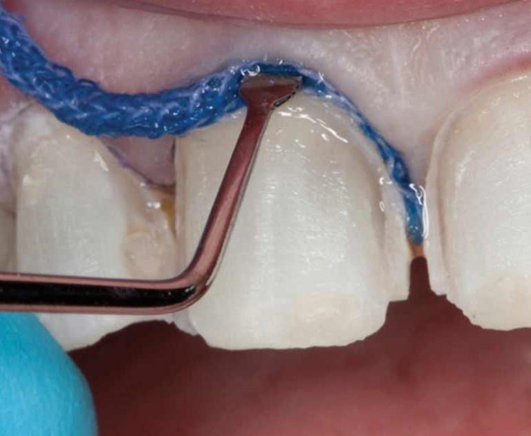Gingival Retraction GINGI PAK gingival-retraction-gingi-pak