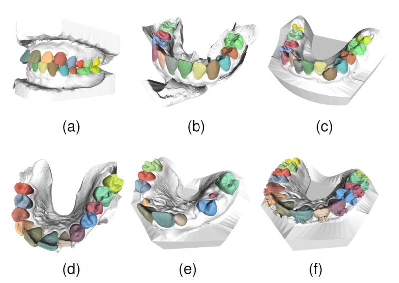 Github Hao Hust Interactive Tooth Separation From Dental Model Using - Best City Arts in Desktop