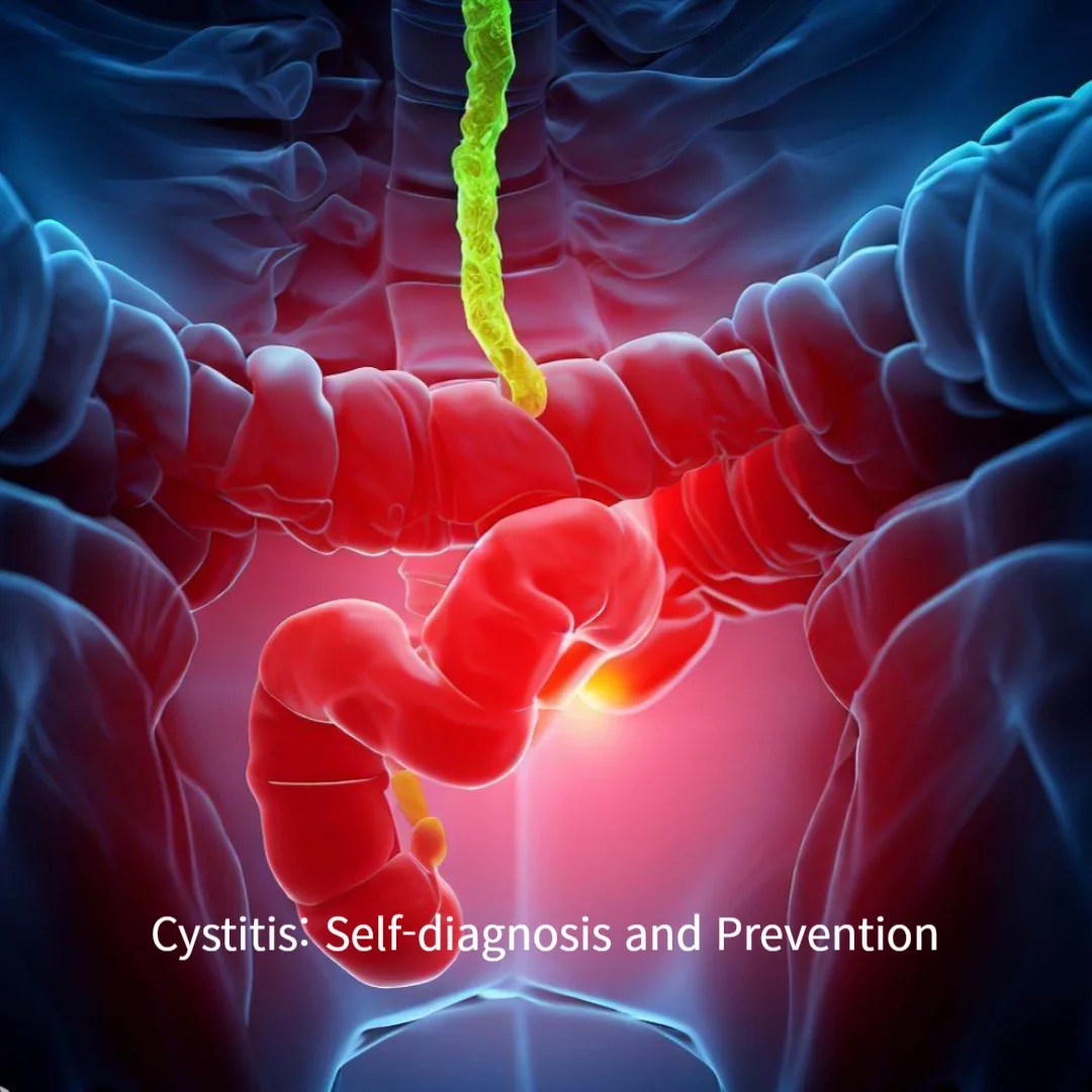 Cystitis: Self-diagnosis and Prevention - healwiki.com
