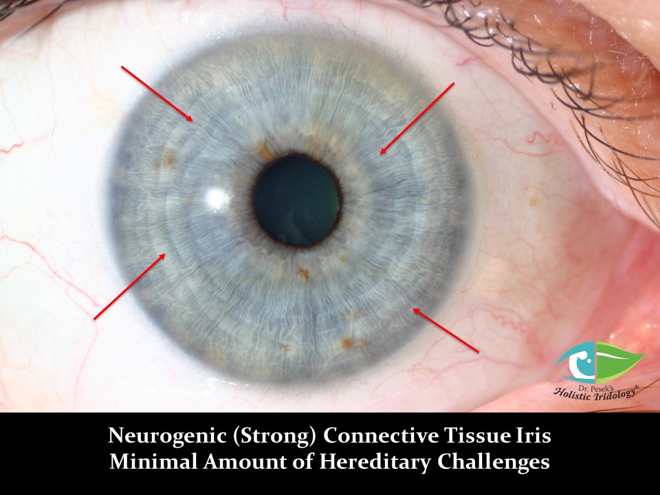 Iris Photos with Interpretation – Dr. Pesek's Holistic Iridology