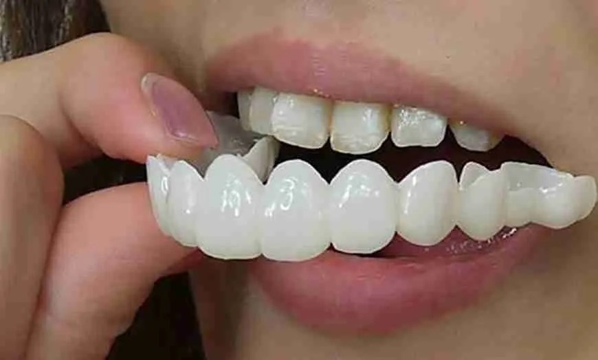 Snap-on Removable Veneers - HoodGrillz