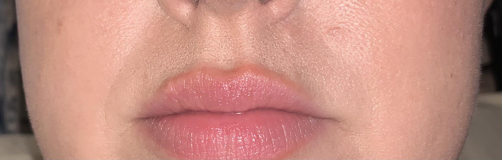 Get The ‘Why does my upper lip look very textured and “scaley”?’ Look ...