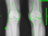 Image Python Calculating The Angle Between Two Bones In An X Ray