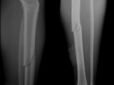 Orthopedics How To Tell If My Leg Fracture Is Healing Health Stack