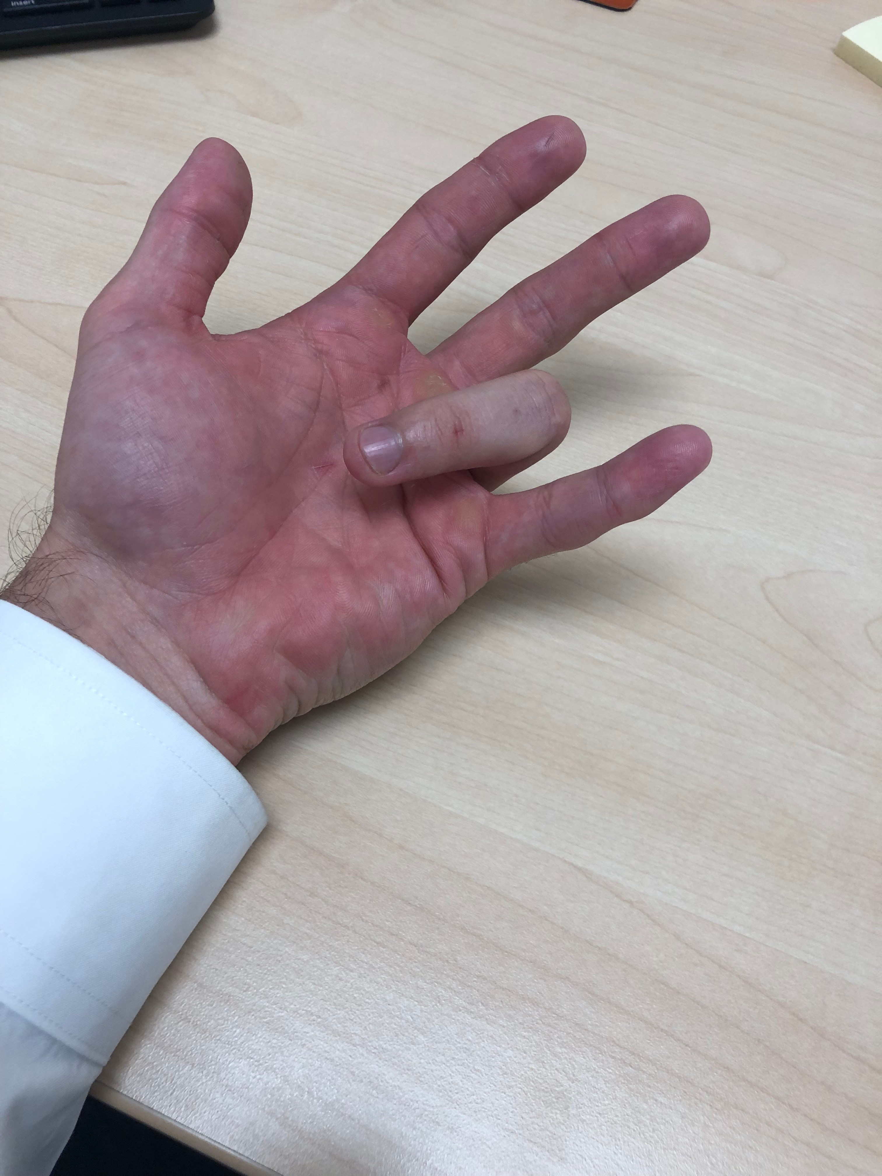 View 27 Stenosing Tenosynovitis - artangelinanewpro137