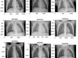 Chest X Ray Covid 19 Pneumonia Kaggle Covid19 Classification