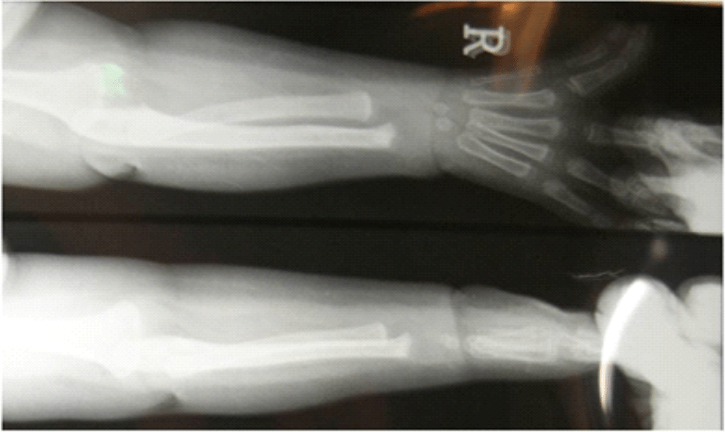 Radial Hemimelia Treatment - Decision Making and Management, Algorithm ...