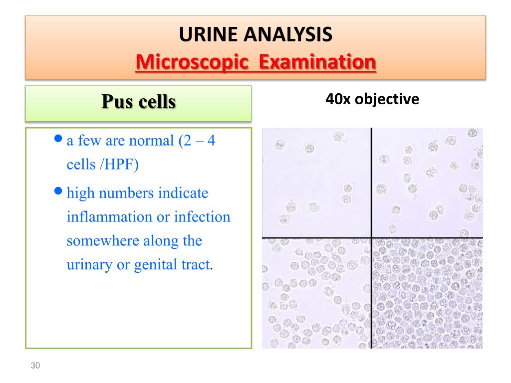 Pus Cells In Urine Range In Hpf pus-cells-in-urine-range-in-hpf