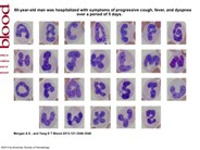 Lymphocytes In Sanfilippo Syndrome Display Characteristic Alder Reilly