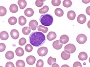 Lymphoblasts 2