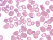 Lead Poisoning Smear Blood Smear Basophilic Stippling In A Red Blood