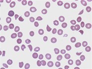 Schistocytes 1