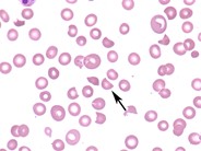 Schistocyte 1