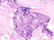 Marrow Fibrosis In Primary Myelofibrosis 2