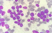 Bone Marrow Filled With Blasts In Acute Lymphoblastic Leukemia All