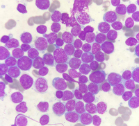 Bone Marrow Filled With Blasts In Acute Lymphoblastic Leukemia All