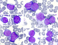 Burkitt Lymphoma