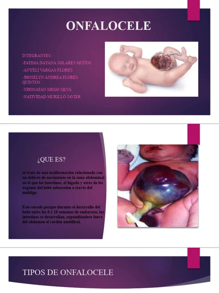 Onfalocele Pdf