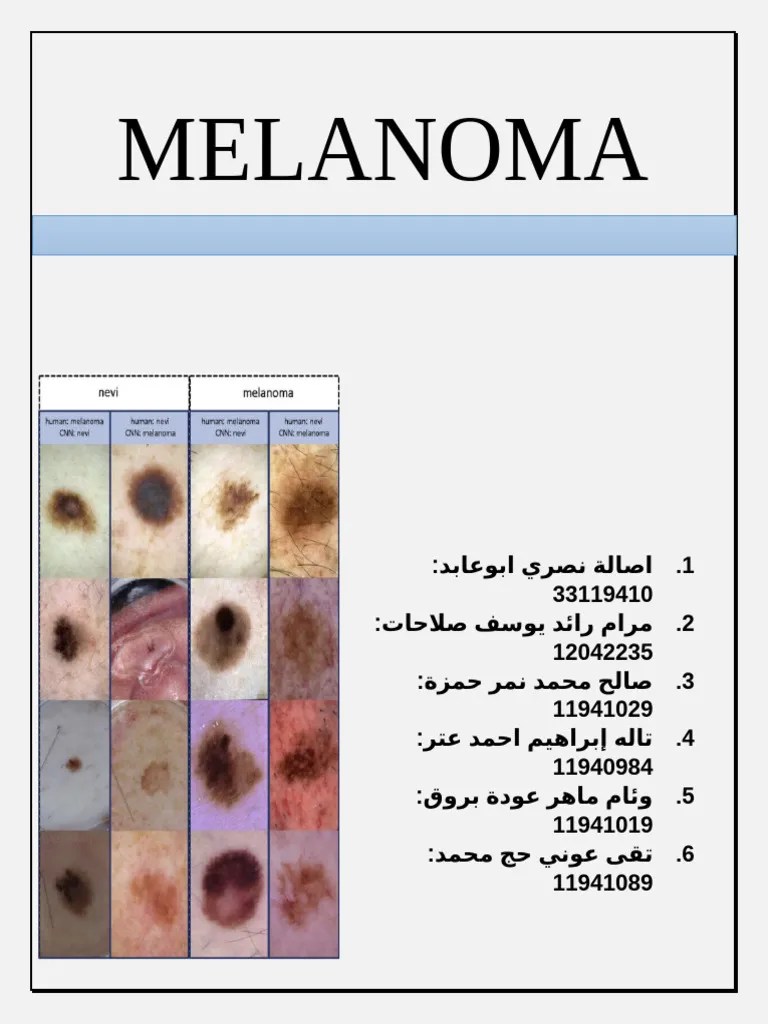 Melanoma Pdf Melanoma Epidermis