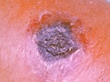 Anthrax Infected Heroin Injecting Advice