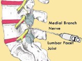Medial Branch Block Ispine