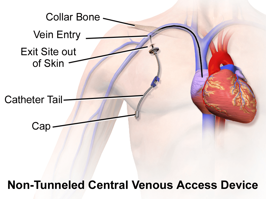 Dialysis Access Management – i-VASCULAR center