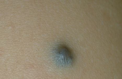 Small Red Moles On Skin: Everything You Need To Know - Just Health And ...