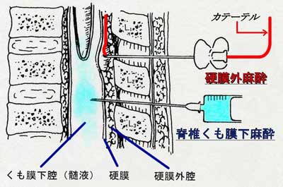 硬膜外麻酔と脊髄くも膜下麻酔の違い｜医学的見地から