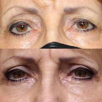 Bilateral Upper and Lower Eyelid Blepharoplasty - Key-Whitman Eye Center