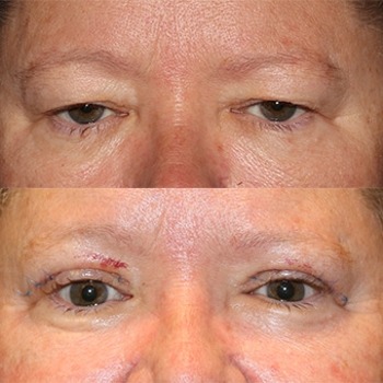 11 Days Post Op Upper Eyelid Blepharoplasty - Front - Key-Whitman Eye ...