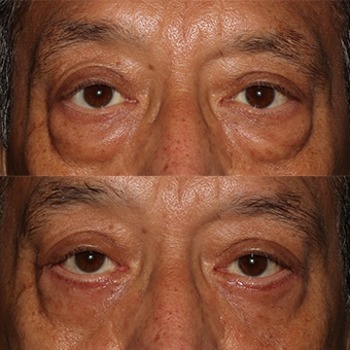 Bilateral Lower Lid Blepharoplasty - Key-Whitman Eye Center