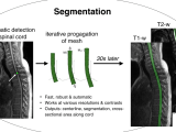 Automatic Spinal Cord Segmentation Neuropoly Lab