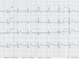Bifascicular Block Litfl Ecg Library Diagnosis