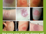 Lyme Disease Tick Bite Rash