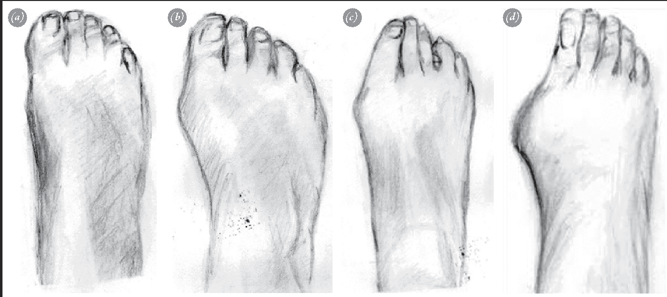 manchester scale | 陳甫銓的物理治療筆記
