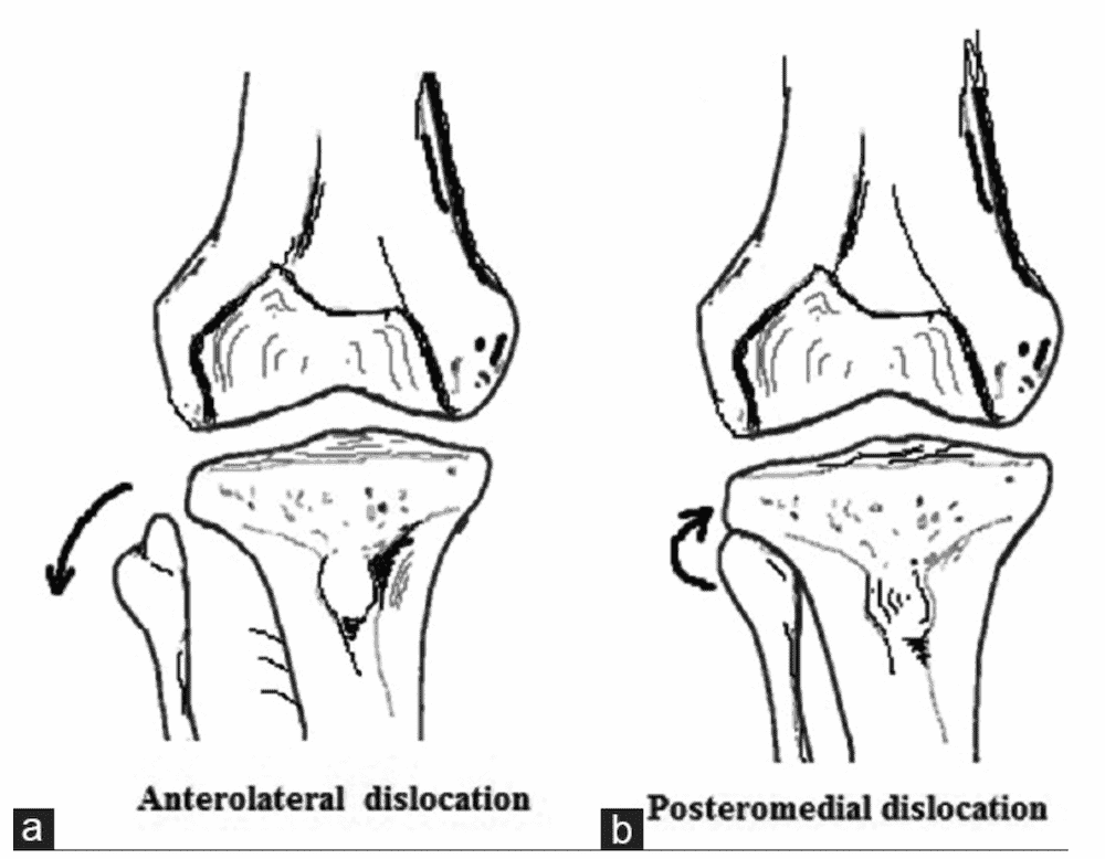 PTFJ-subluxation | 陳甫銓的物理治療筆記