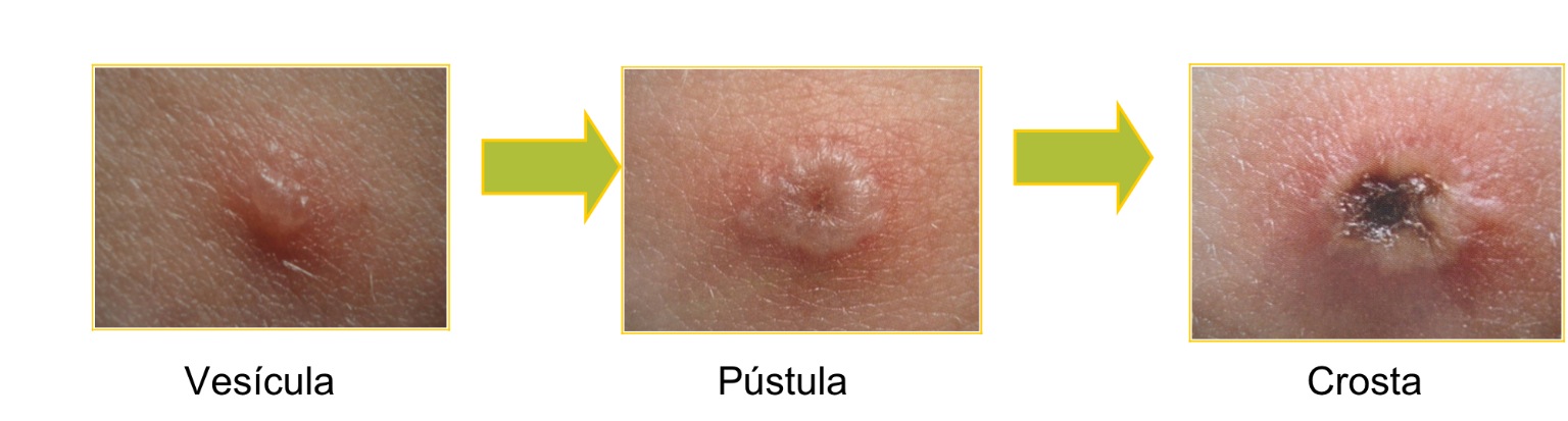 Tudo o que os pais precisam saber sobre a varicela