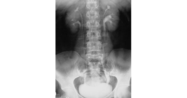 Renal Diagnostics(Pyelogram,Urogram,Nephrogram,Cystourethrogram ...