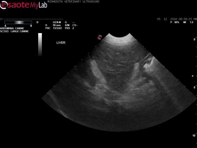 Ascites and reactive echogenic fat adjacent to the liver in a 14 year ...