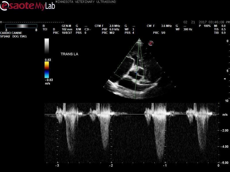 Right to left VSD, right ventricular hypertrophy, and RA dilation in a ...