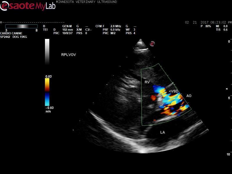 Right to left VSD, right ventricular hypertrophy, and RA dilation in a ...
