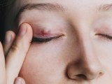 Chalazion Cincinnati Eye Infections Florence Ky Midwest Eye