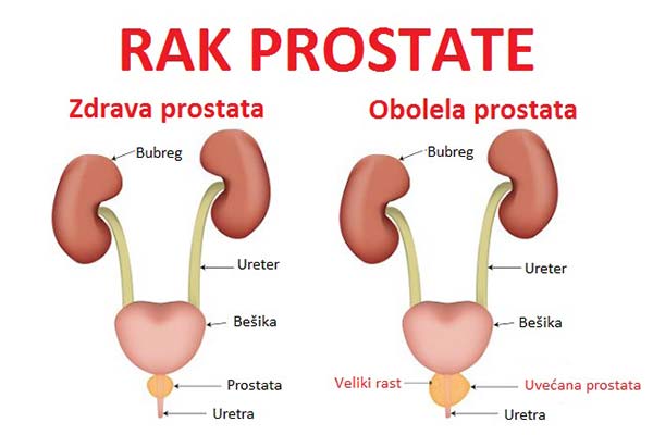 Rak prostate - simptomi | Jelena Vukicevic: KARCINOM PROSTATE