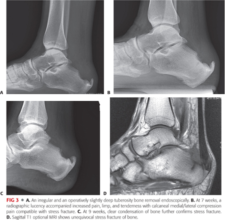 Retrocalcaneal Bursoscopy | Musculoskeletal Key