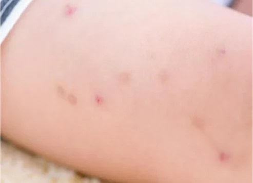 Bed Bugs Eggs In Skin