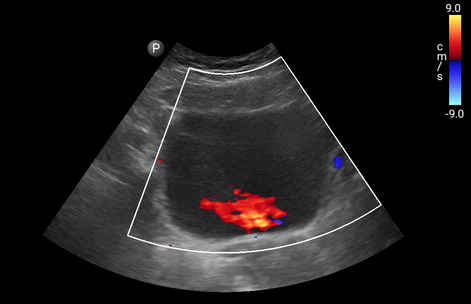 Ureteral jets – NephroPOCUS
