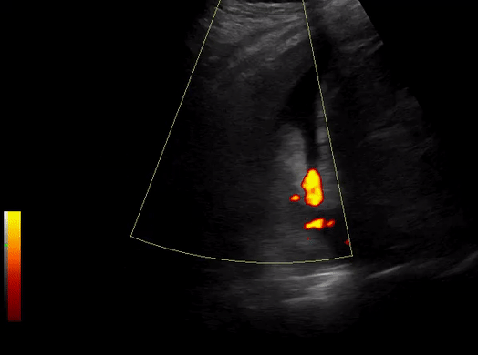 This jellyfish is not atelectasis! – NephroPOCUS