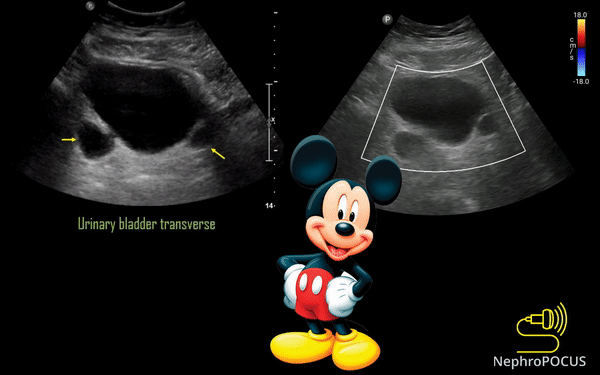 Urinary bladder diverticula – The Mickey Mouse sign – NephroPOCUS